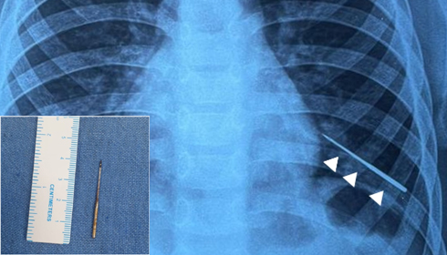 AIIMS doctors remove 4-cm needle from child’s lung