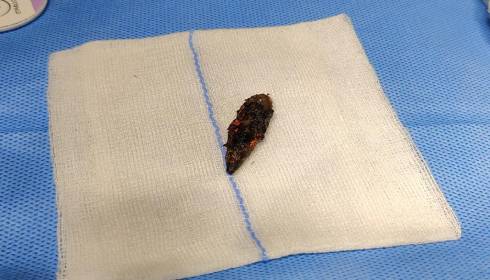 Astonishing Medical Success: Yemeni Patient's 18-Year Battle Ends as ...