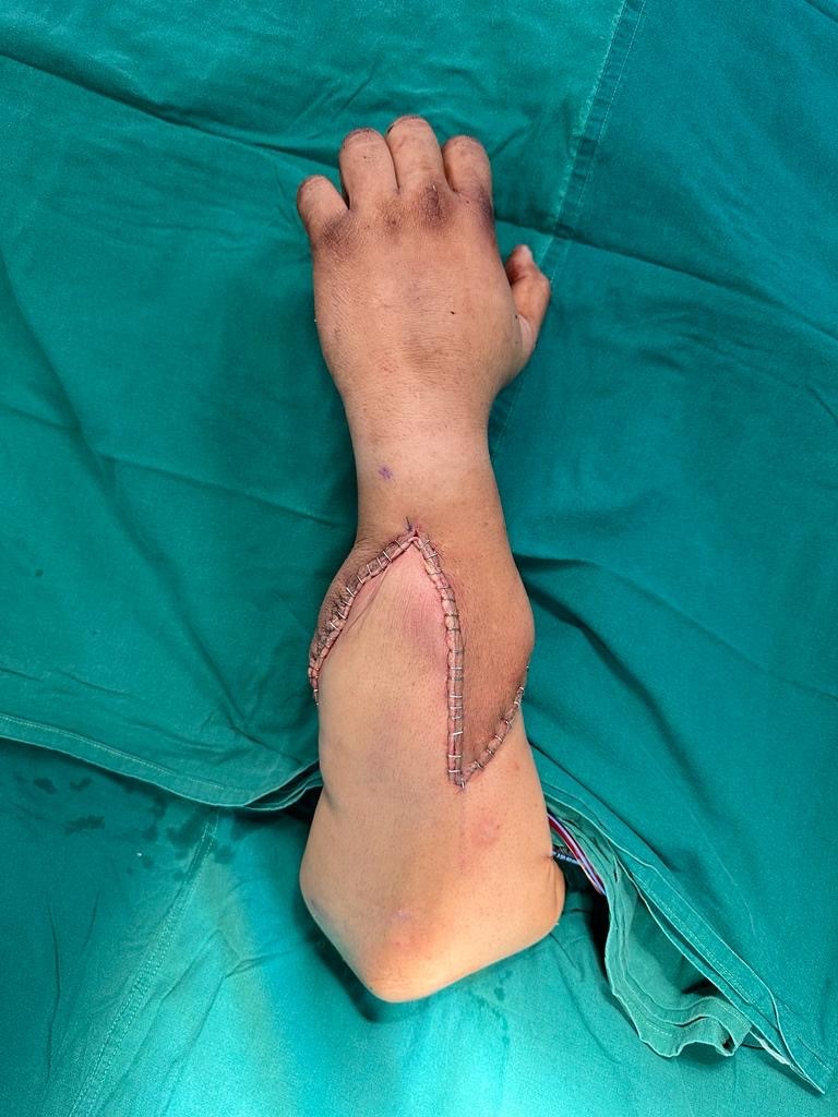 Historic Hand Transplantation Success at Amrita Hospital Faridabad ...