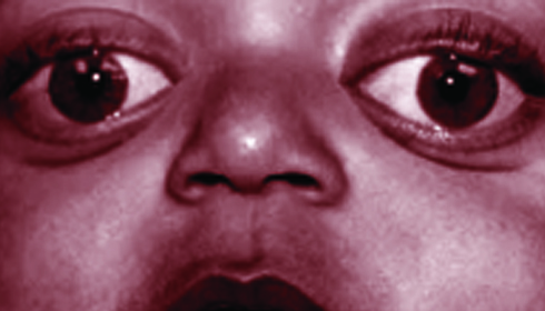 Hajdu-Cheney Syndrome: Genetic Causes, Symptoms, and Management