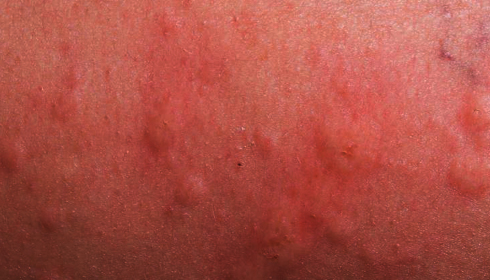 Aquagenic Urticaria: Understanding the Rare Water Allergy