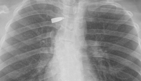 Healing Hands of Bengaluru: Successful Surgery Removes Bullet Embedded ...