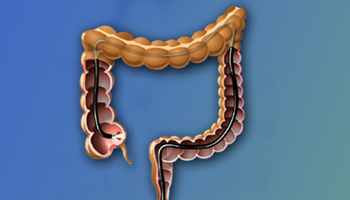The Significance of Having a Colonoscopy
