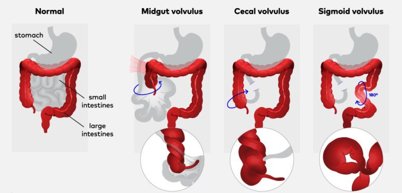 Midgut Volvulus Abnormal Rotation And Fixation Of The Intestine